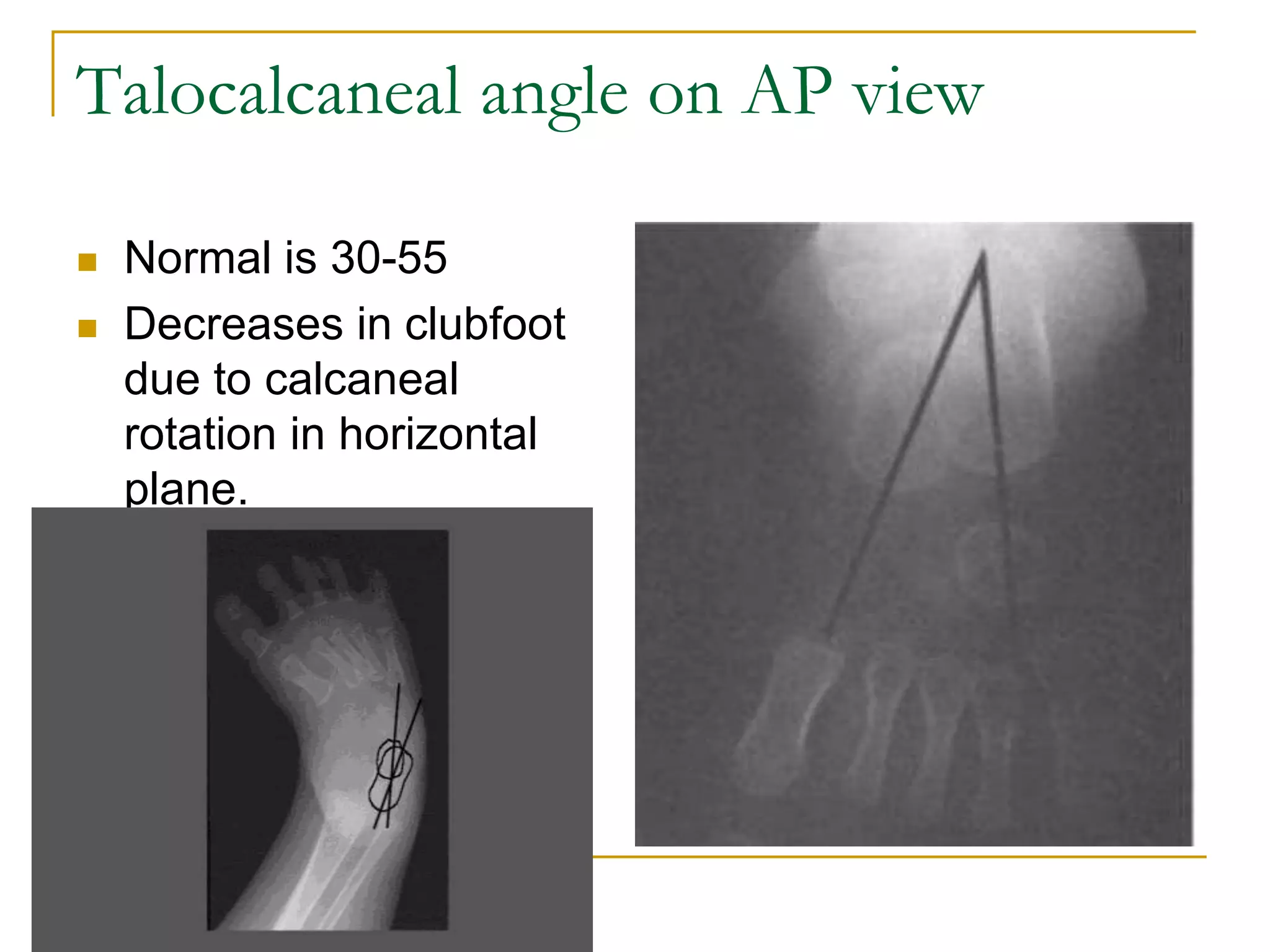 Pediatric foot deformities | PPT