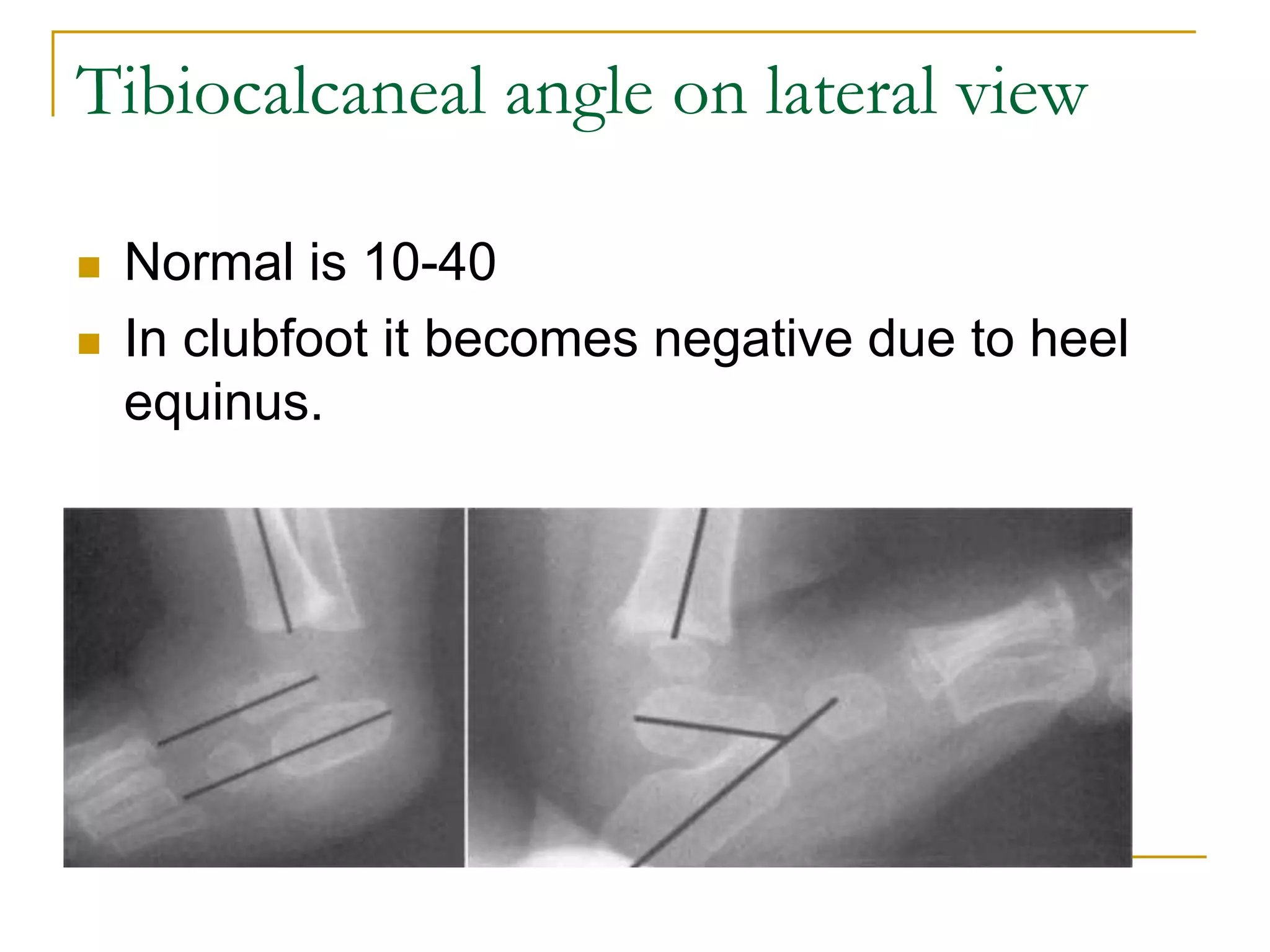 Pediatric foot deformities | PPT