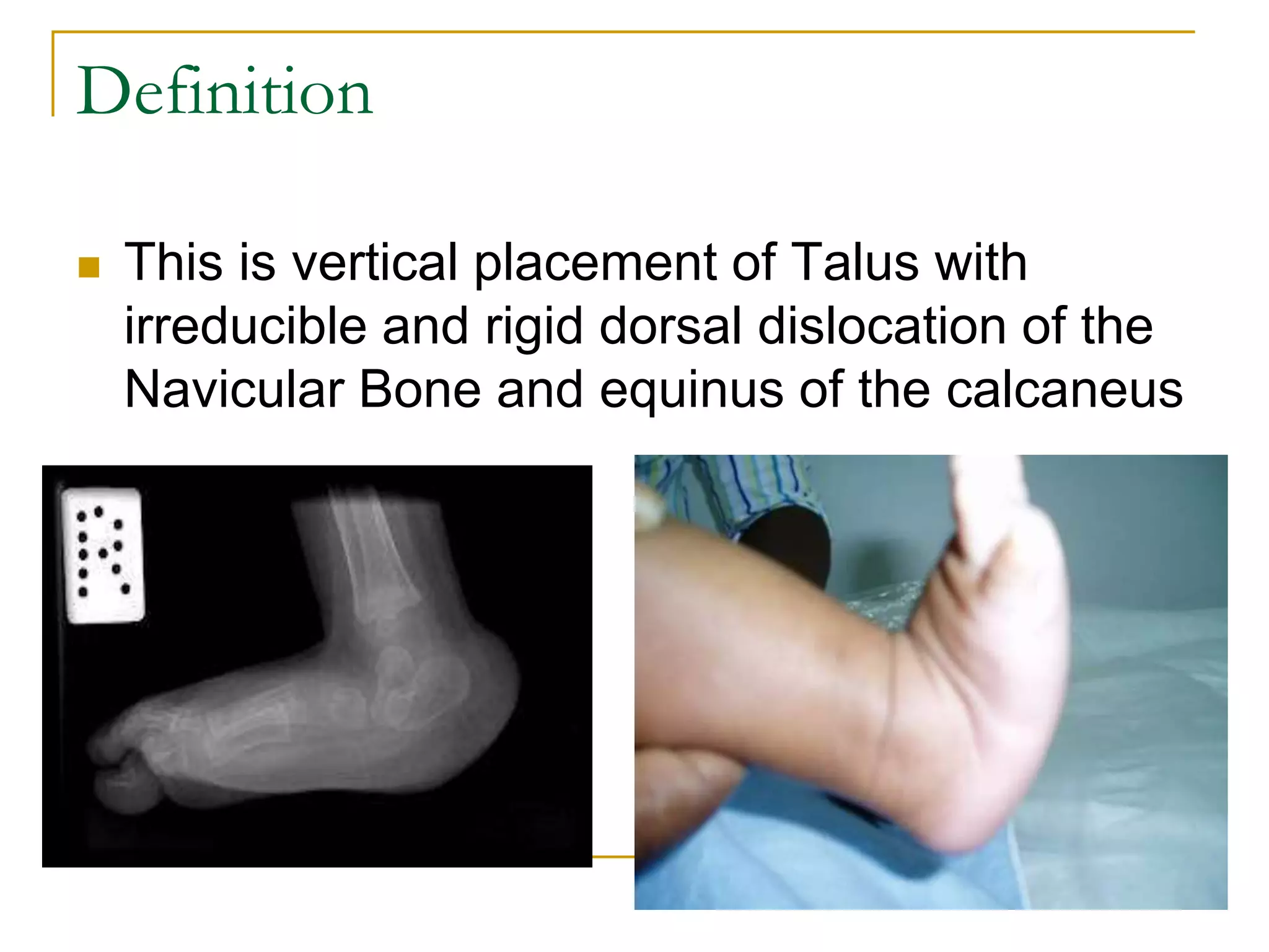 Pediatric foot deformities | PPT