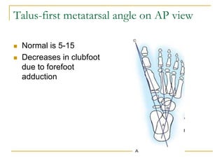 Pediatric foot deformities | PPT