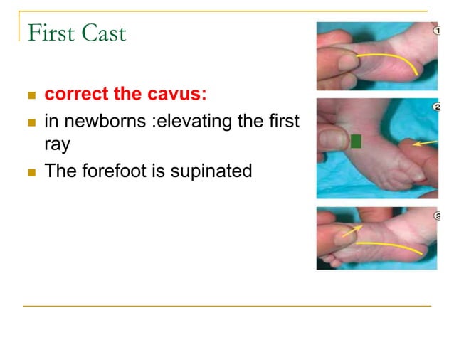 Pediatric foot deformities | PPT | Death, Injury, or Military Conflict ...