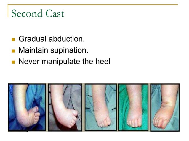 Pediatric foot deformities | PPT | Death, Injury, or Military Conflict ...