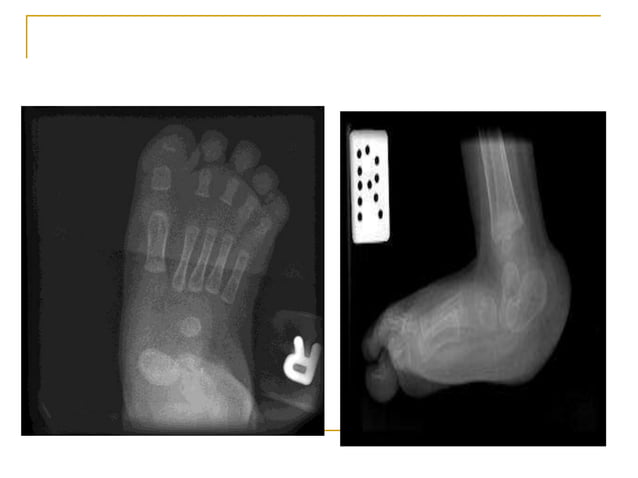 Pediatric foot deformities | PPT | Death, Injury, or Military Conflict ...