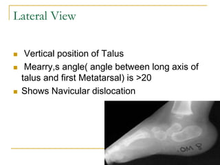 Pediatric foot deformities | PPT