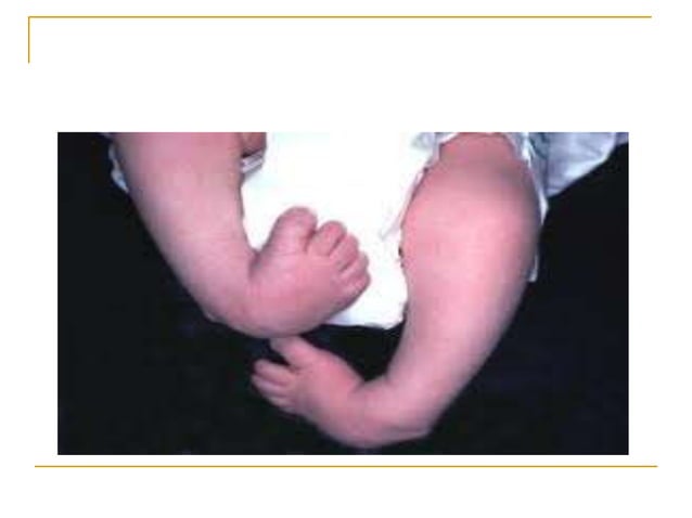 Pediatric foot deformities | PPT | Death, Injury, or Military Conflict ...