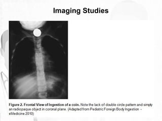 Pediatric foreign body ingestion | PPT