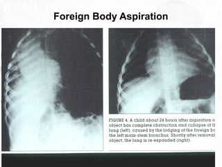 Pediatric foreign body ingestion | PPT