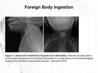 Pediatric foreign body ingestion | PPT