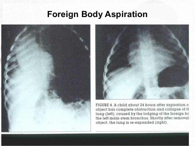 Pediatric foreign body ingestion