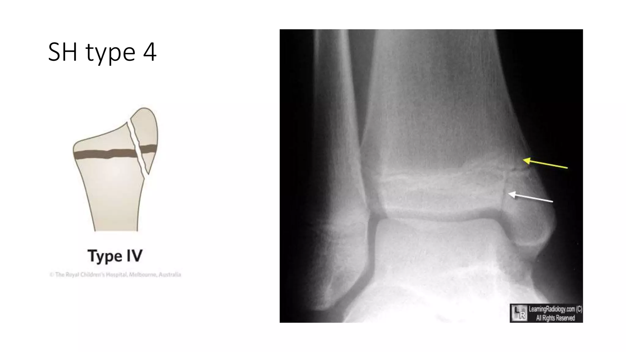 Pediatric Fractures.pptx