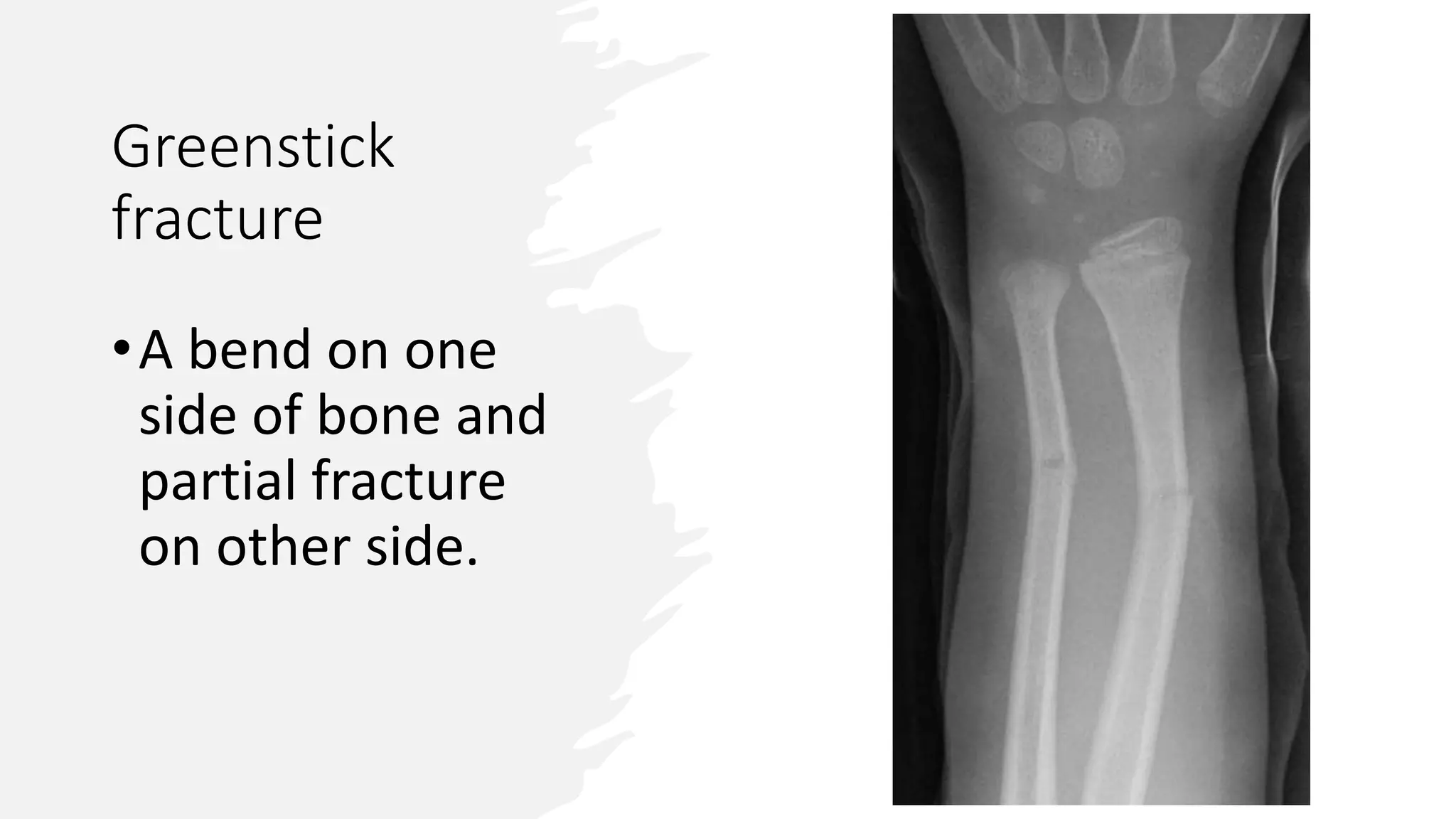 Pediatric Fractures.pptx