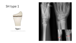 Pediatric Fractures.pptx
