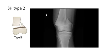 Pediatric Fractures.pptx