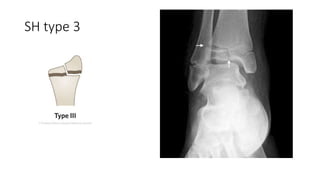 Pediatric Fractures.pptx