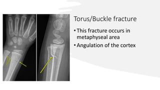 Pediatric Fractures.pptx