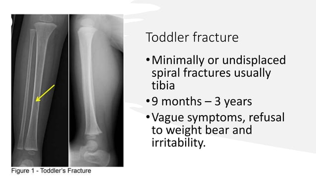 Pediatric Fractures.pptx