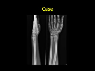 Pediatric_Fractures_QT.pdf