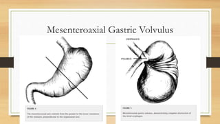 Pediatric Gastric Volvulus | PPTX