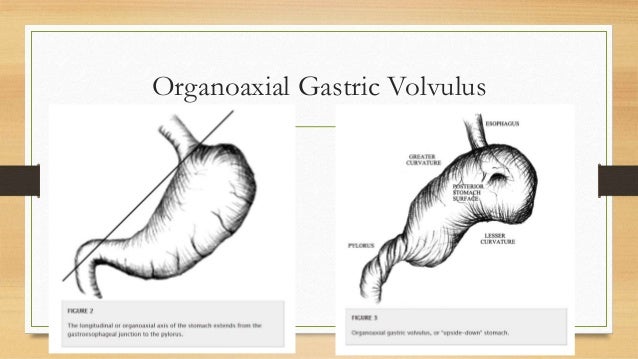 Pediatric Gastric Volvulus