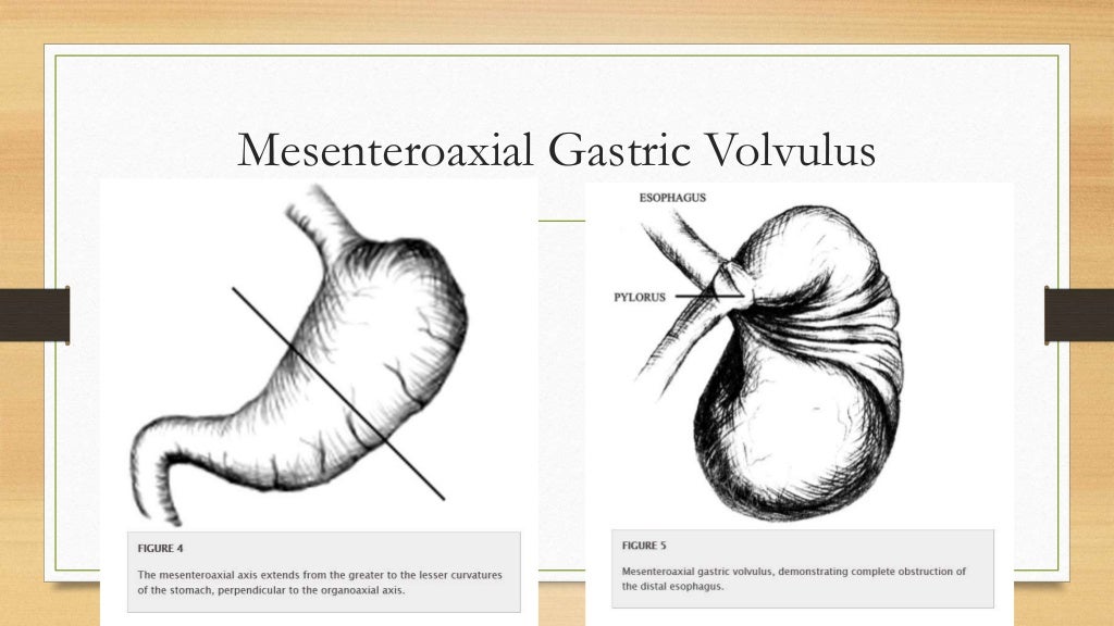 Pediatric Gastric Volvulus