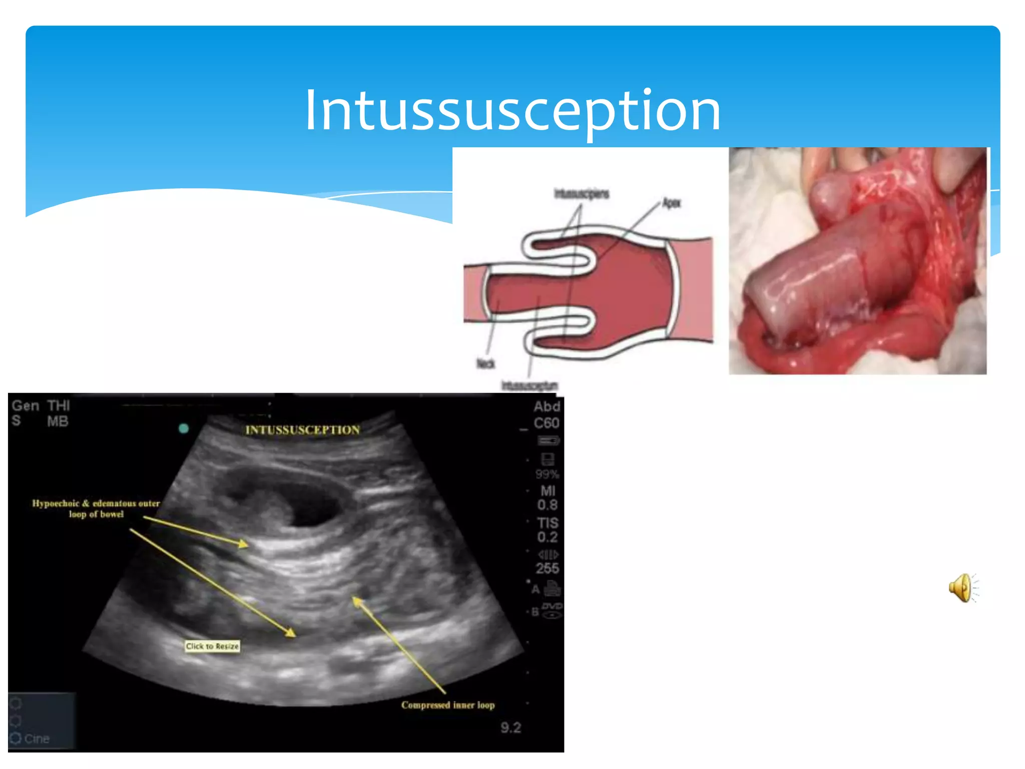 Pediatric gastrointestinal disorders | PPTX
