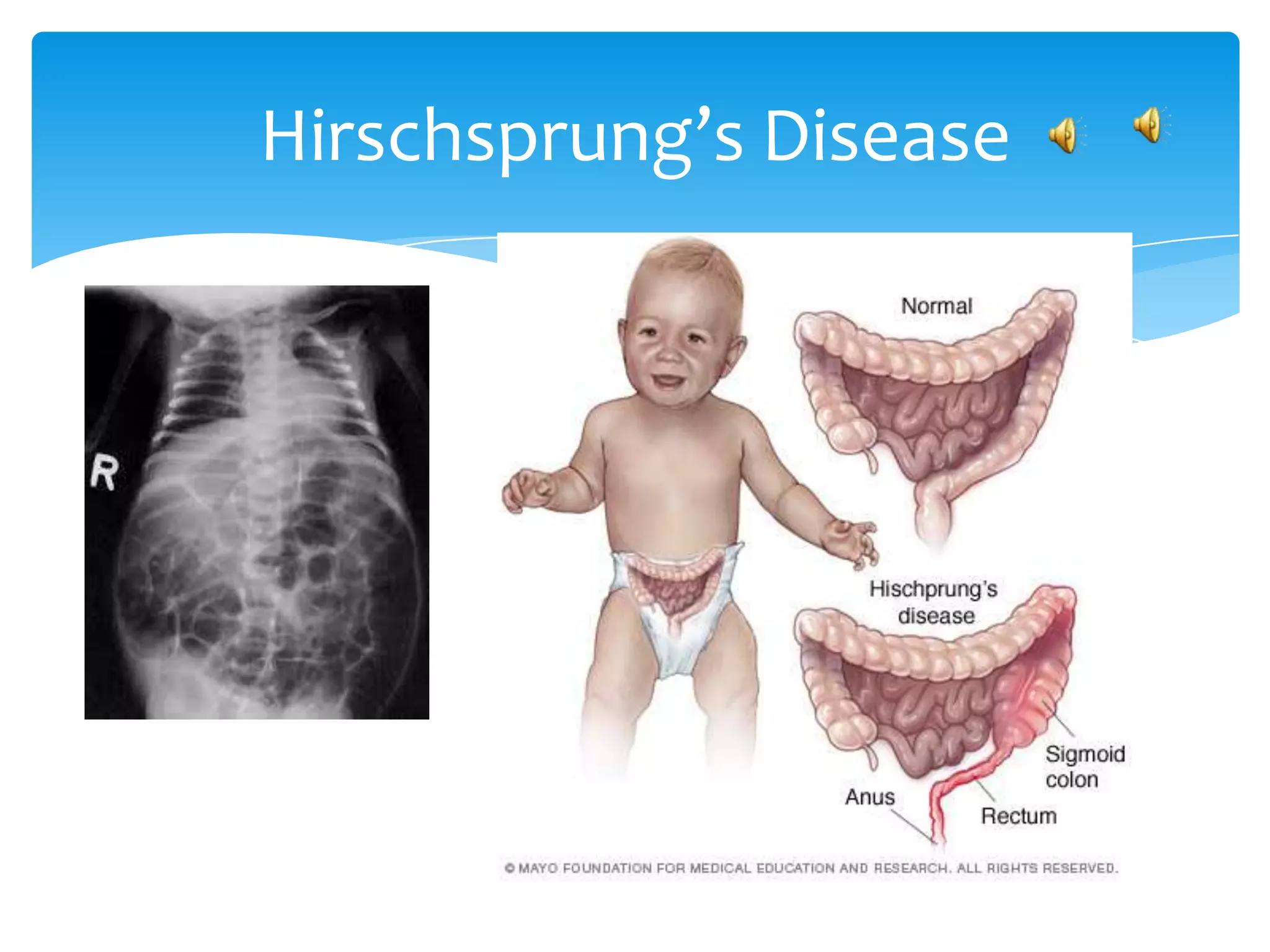 Pediatric gastrointestinal disorders | PPTX
