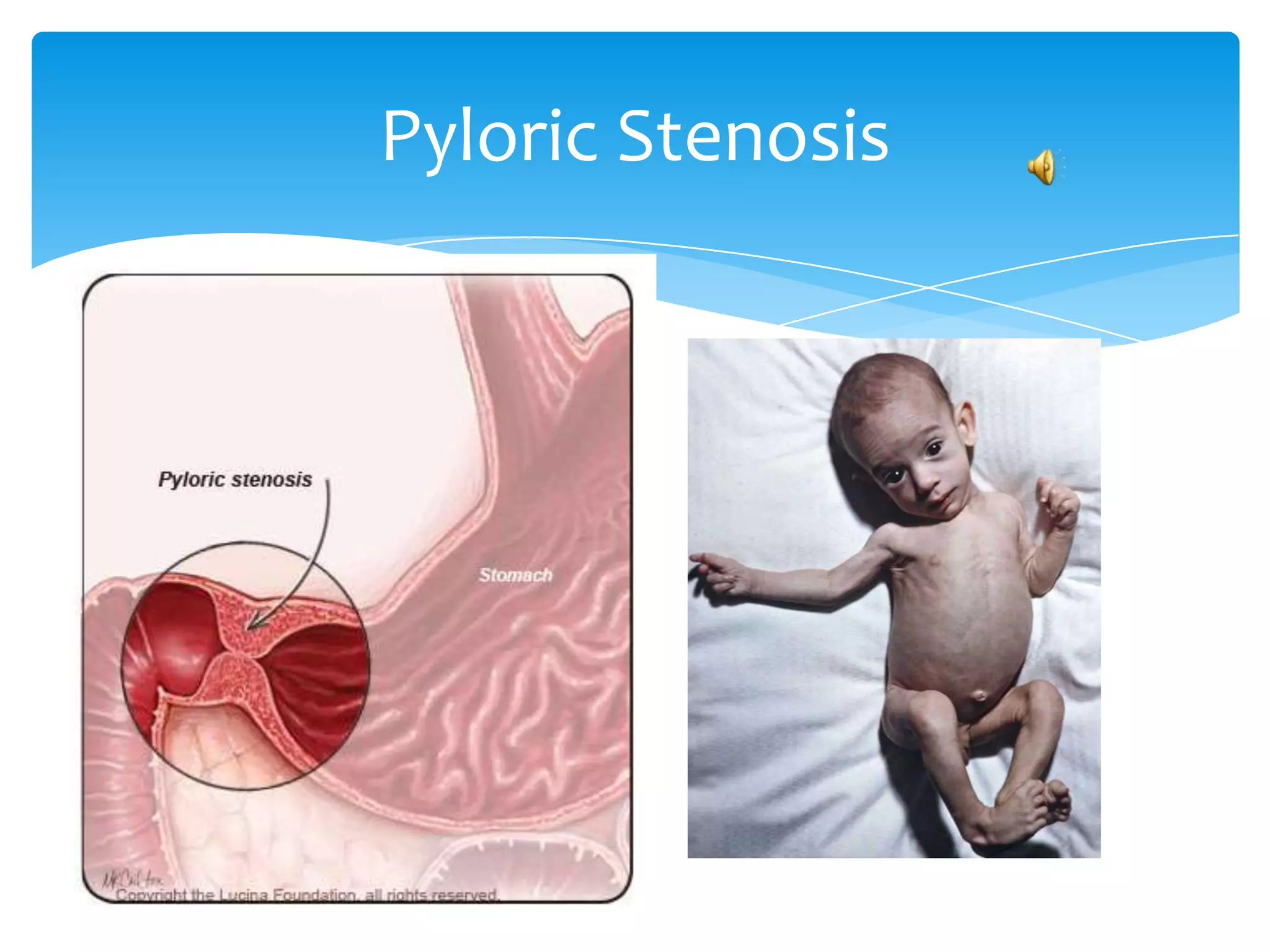 Pediatric gastrointestinal disorders | PPTX