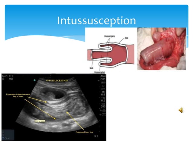Pediatric gastrointestinal disorders | PPTX | Digestive Disorders ...
