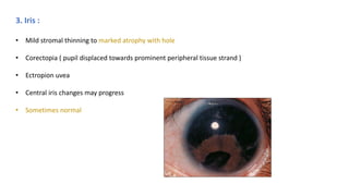 Pediatric glaucomas | PDF