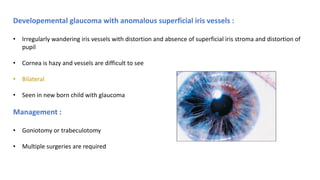 Pediatric glaucomas | PDF