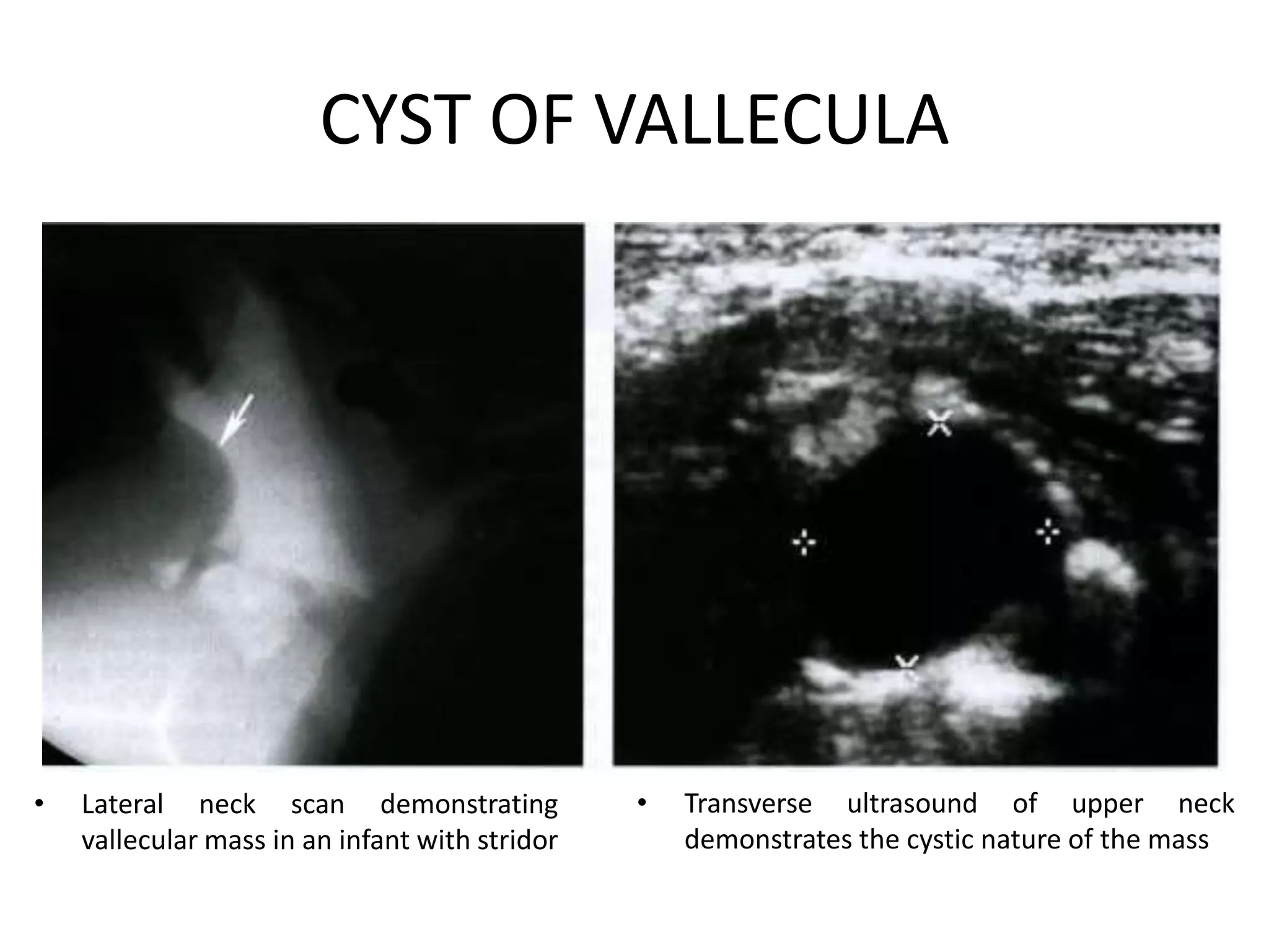 Pediatric head and neck masses | PPTX