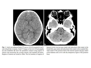 Pediatric head CT | PPT