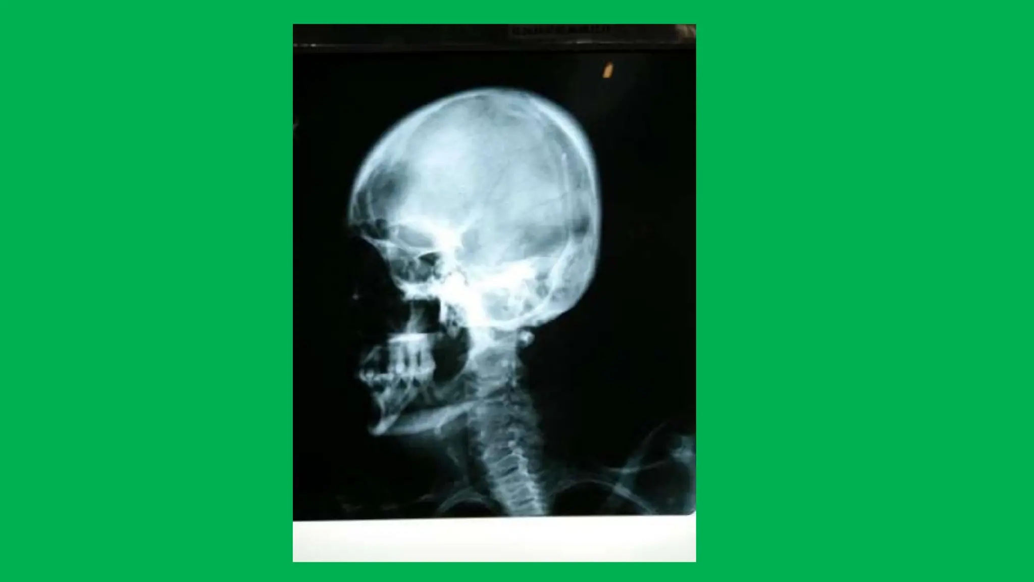 Pediatric Head Trauma Imaging - dr. Sonny G.R. Saragih Sp.BS.pptx