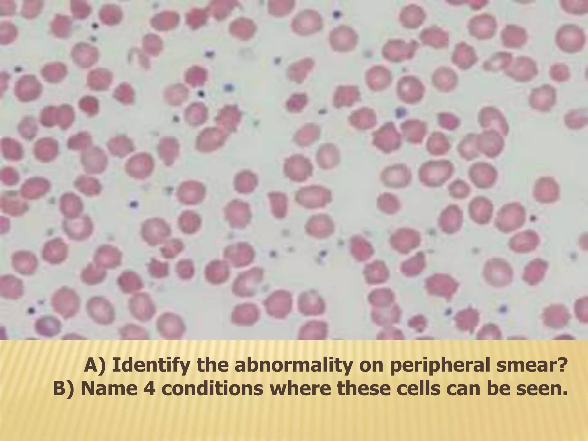 Pediatric Hematology Cases ppt.pptx