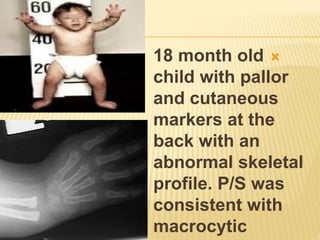 Pediatric Hematology Cases ppt.pptx