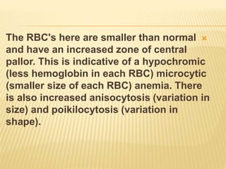 Pediatric Hematology Cases ppt.pptx