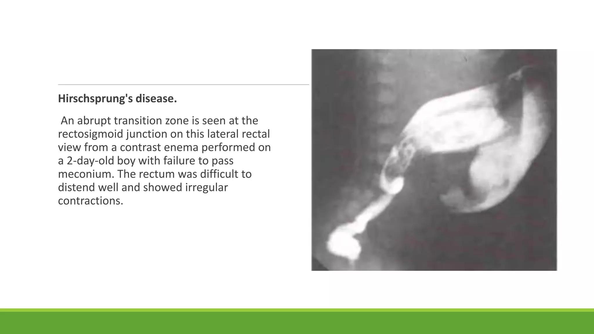 Pediatric High and Low intestinal Obstruction.pptx