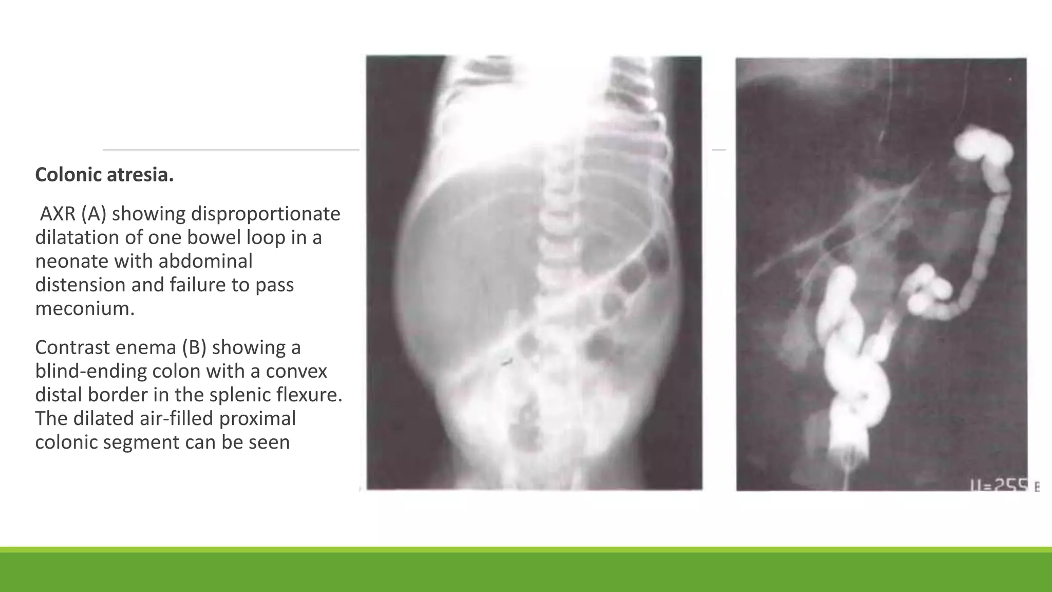 Pediatric High and Low intestinal Obstruction.pptx