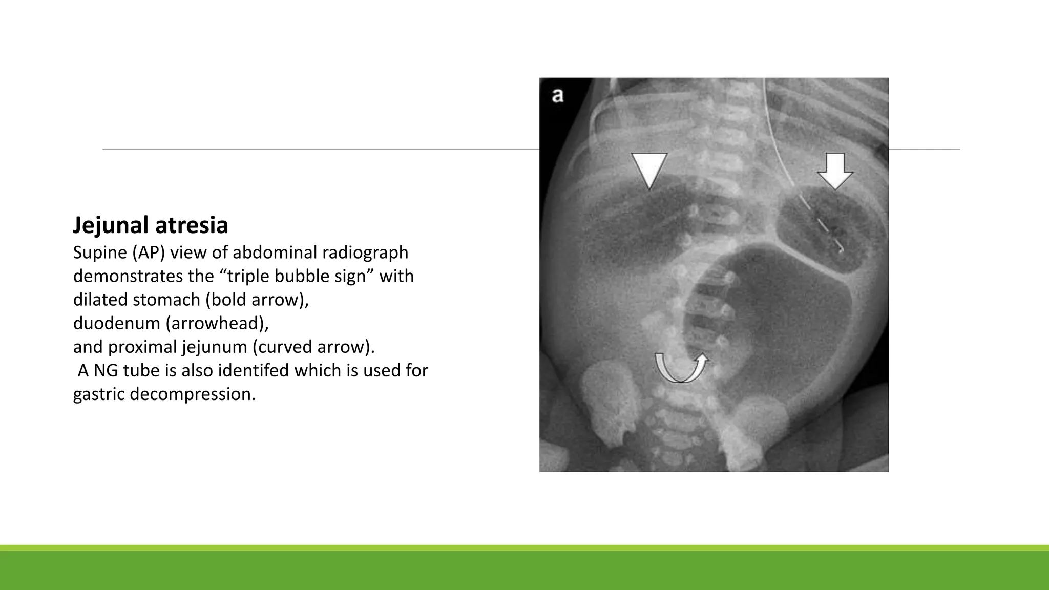Pediatric High and Low intestinal Obstruction.pptx