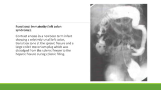 Pediatric High and Low intestinal Obstruction.pptx