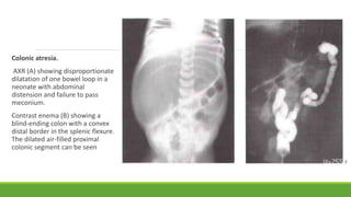 Pediatric High and Low intestinal Obstruction.pptx