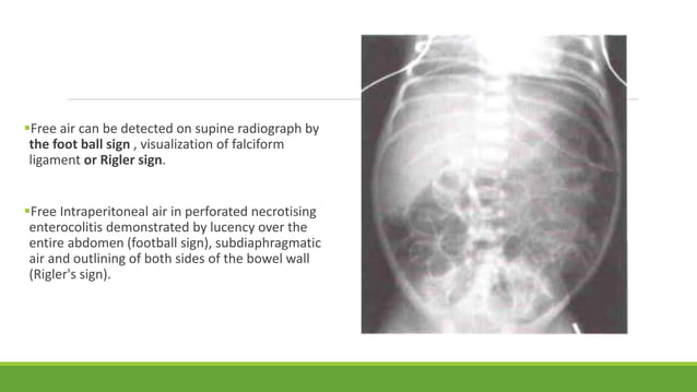 Pediatric High and Low intestinal Obstruction.pptx