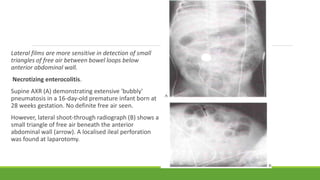 Pediatric High and Low intestinal Obstruction.pptx