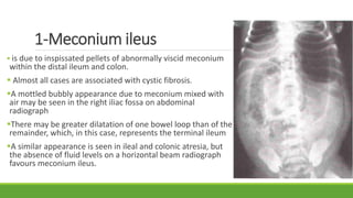 Pediatric High and Low intestinal Obstruction.pptx