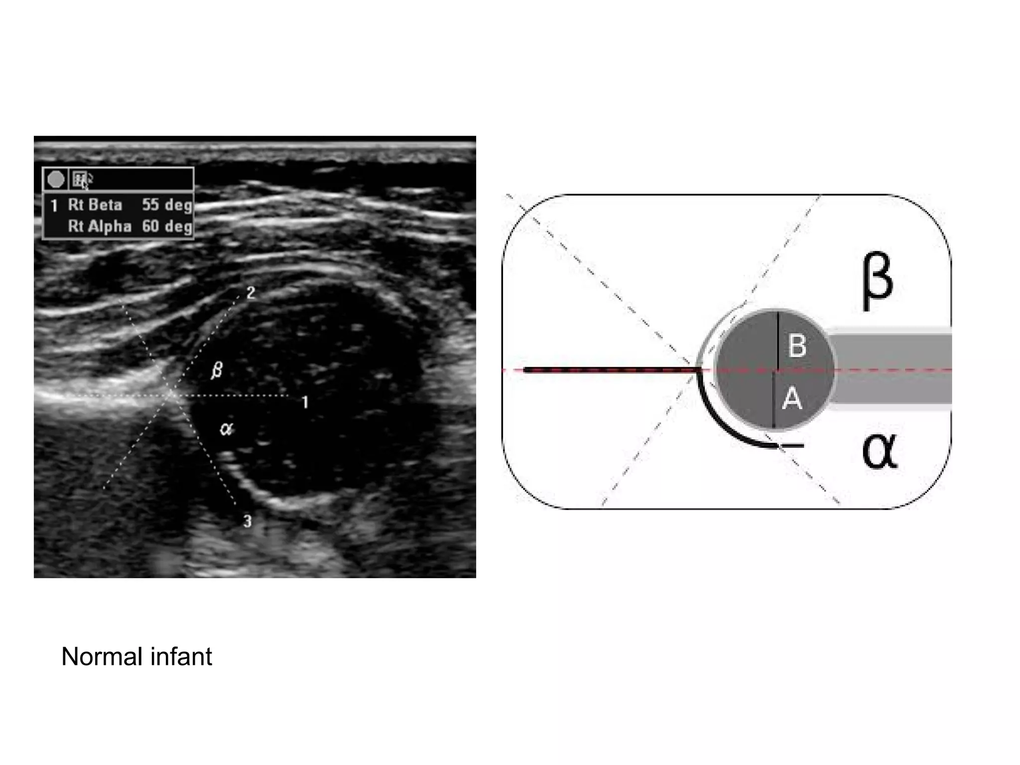 Diagnostic Imaging of Pediatric Hip Lesions | PPT