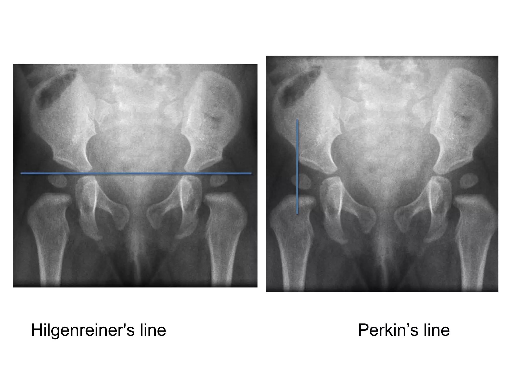 Diagnostic Imaging of Pediatric Hip Lesions | PPT