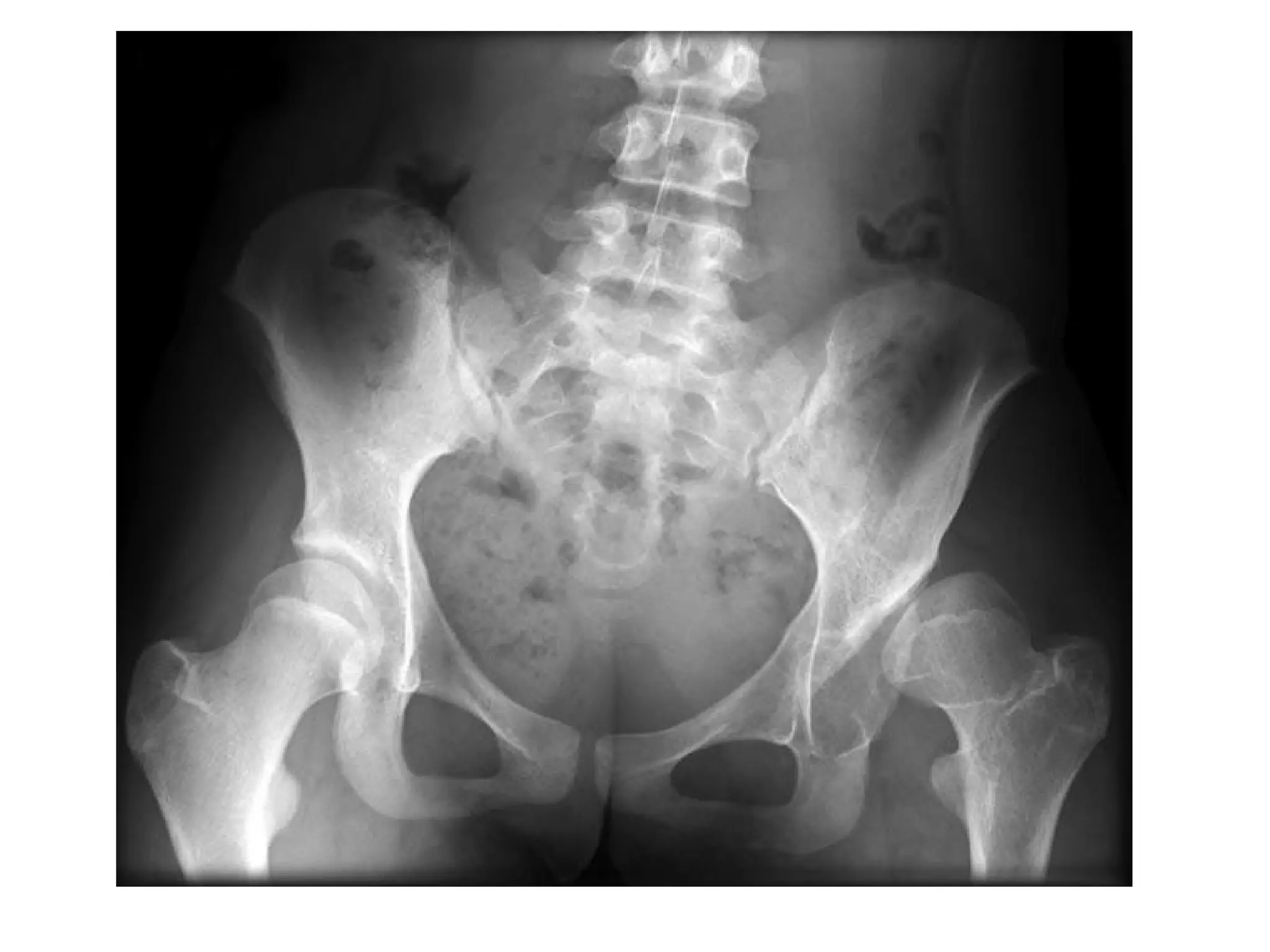 Diagnostic Imaging of Pediatric Hip Lesions | PPT