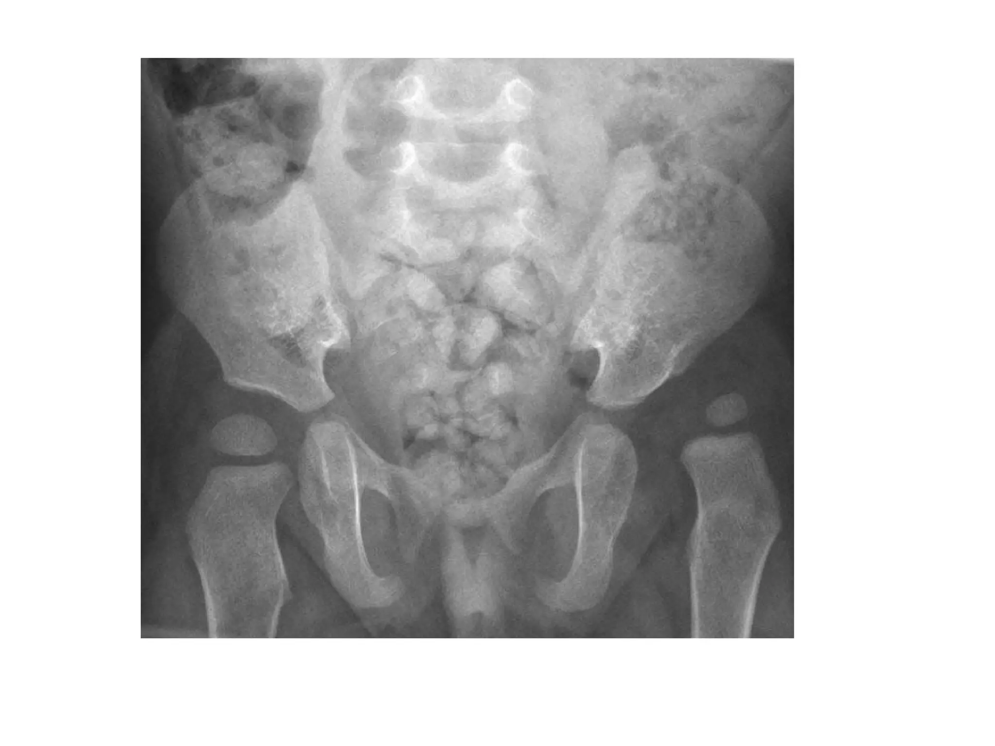 Diagnostic Imaging of Pediatric Hip Lesions | PPT