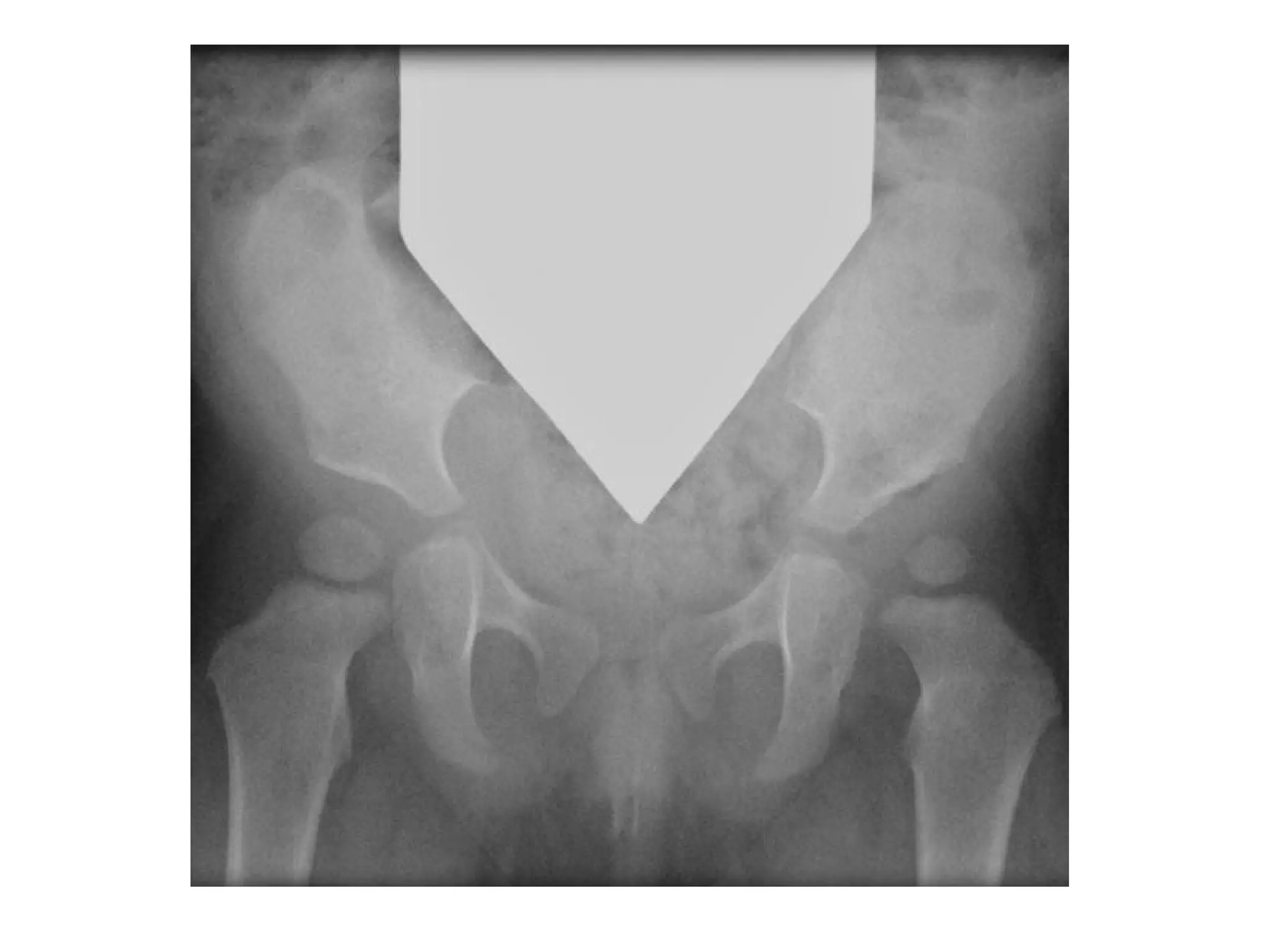 Diagnostic Imaging of Pediatric Hip Lesions | PPT