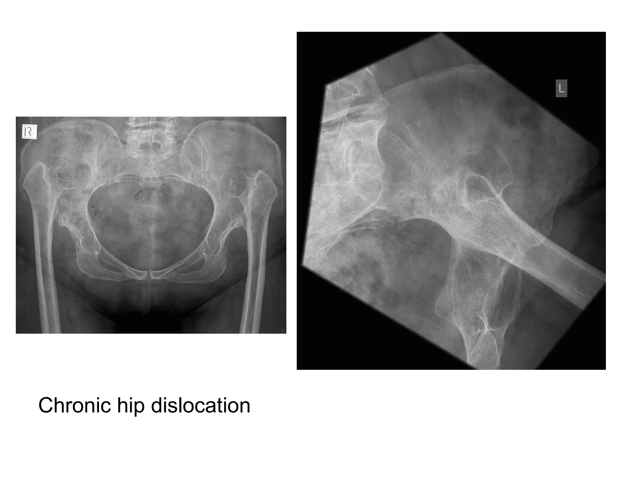 Diagnostic Imaging of Pediatric Hip Lesions | PPT